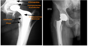 Prótese da Anca ou Artroplastia da Anca - Cuidados a ter – HUB da Saúde